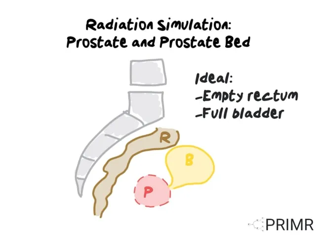 PRIMR | Prostate Cancer Radiation Simulation Procedure - Patient ...