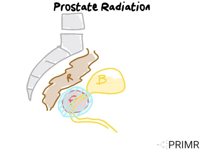 PRIMR | What is Radiation for Prostate Cancer?