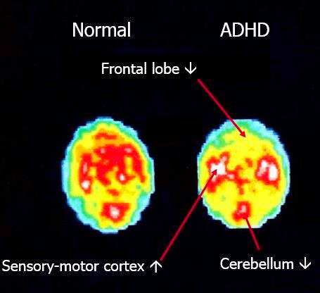 Normal Brain vs ADHD Brain: Differences, Similarities, and Management Strategies
