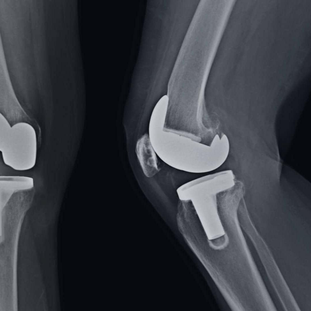 Exactech Recall Lawsuit | Knees, Ankles and Hip Implants