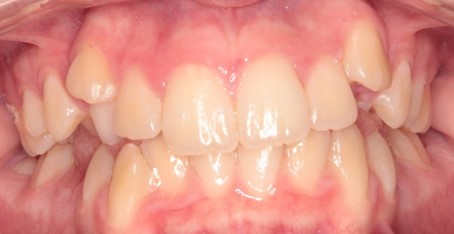 Smiles Gallery - Collins-Higgins Orthodontics