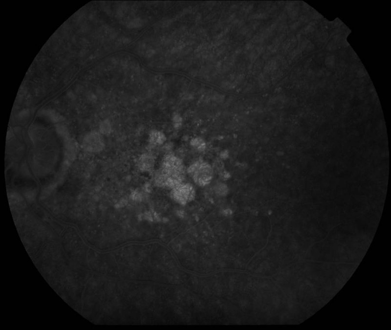 Øyesenteret - Fluorescein angiografi