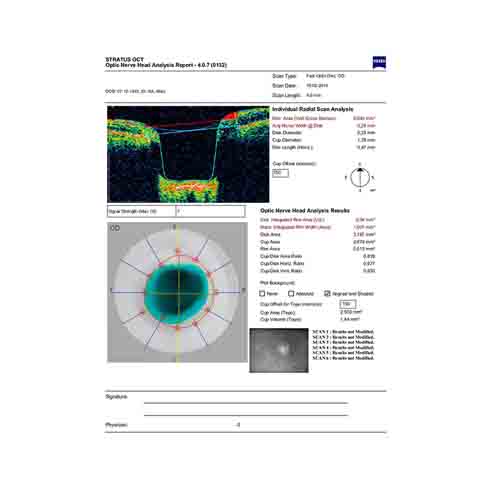 Øyesenteret - OCT - En billeddiagnostisk metode til å registrere ...