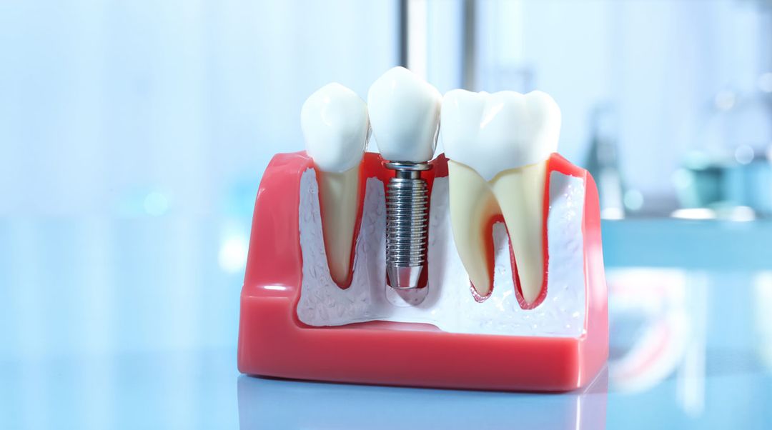 Temporary vs Permanent Dentures: What’s The Difference? - UR Dental ...