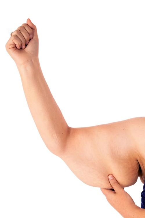 Brachioplasty (Arm Lift/Arm Reduction) Before and After