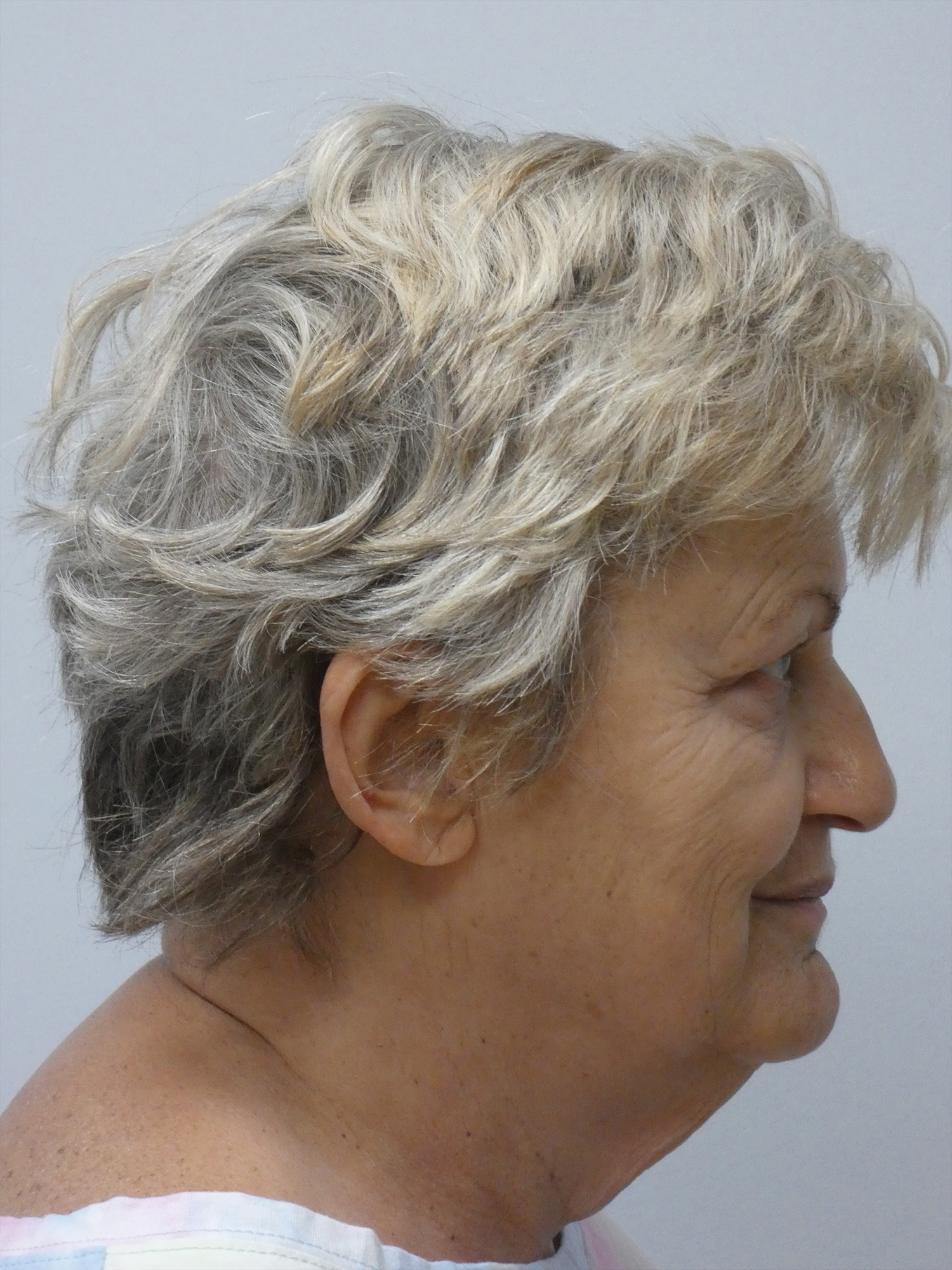 Facelift | Dr. George Parras M.D.