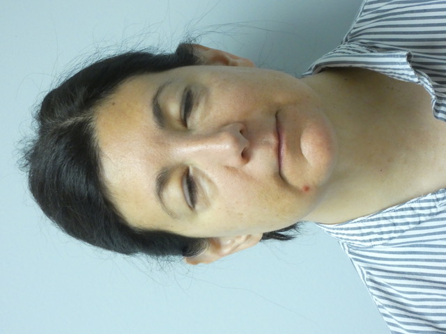 Facelift | Dr. George Parras M.D.