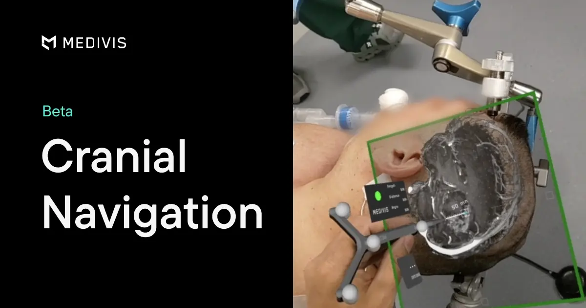 Holographic cranial navigation with sub-millimeter accuracy.