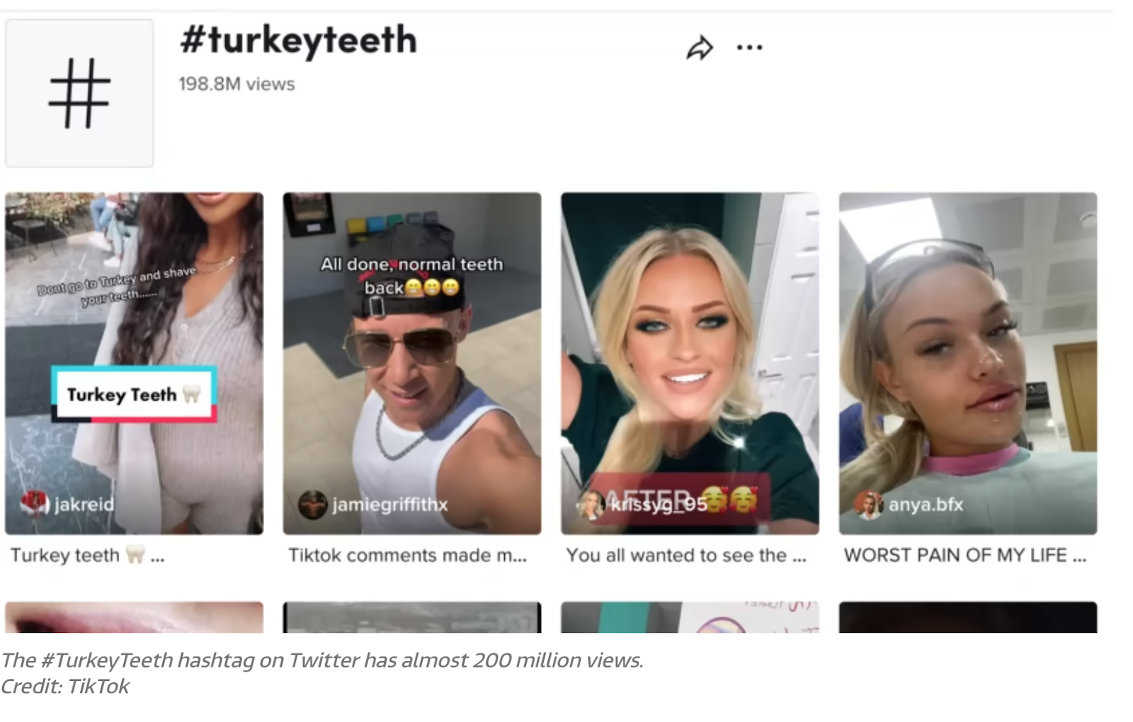 Explained: What is Turkey Teeth? – Bow Lane Dental Group