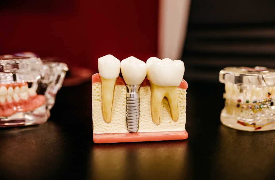 Root Canal vs Extraction: What's the Difference | Bow Lane Dental Group