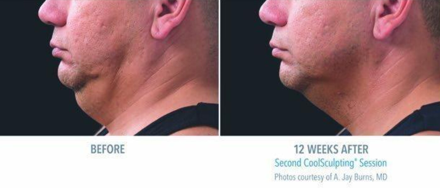 CoolSculpting® or CoolSculpting® Elite | Houston's Top Med Spa ...