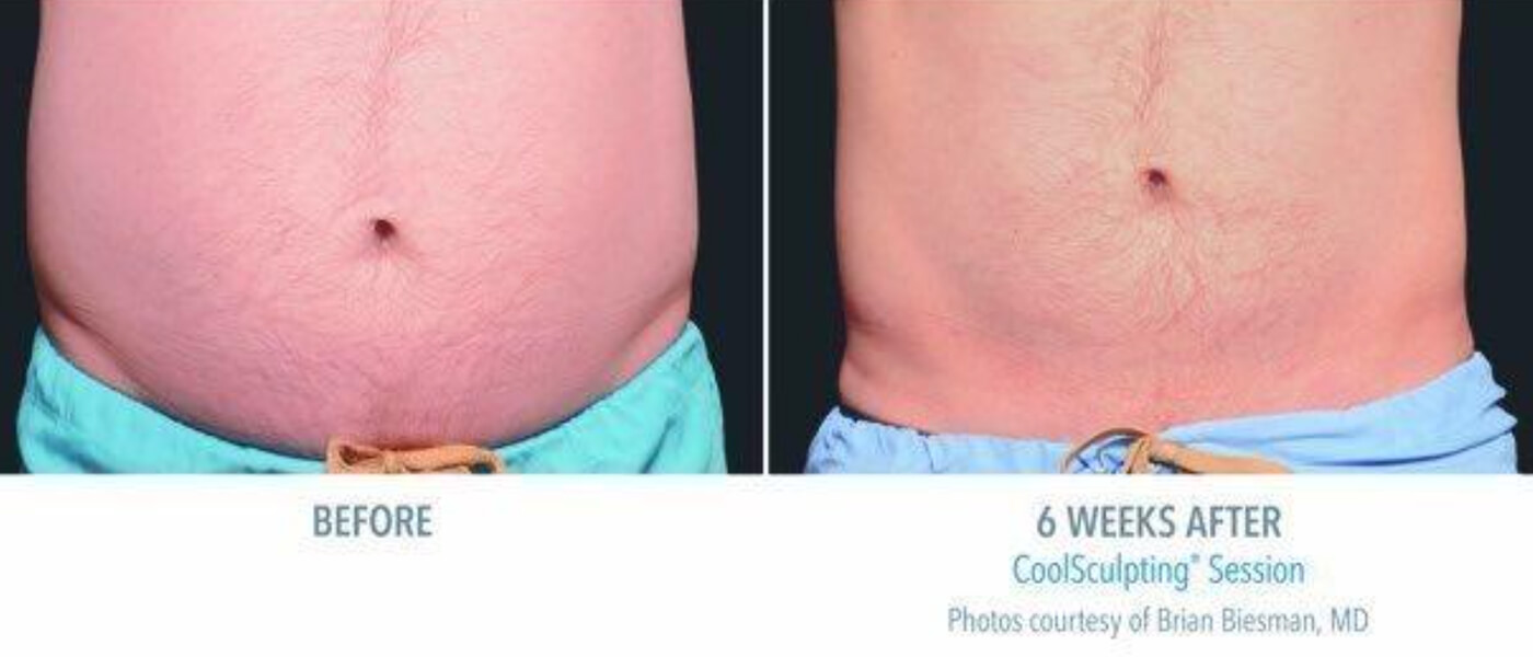 CoolSculpting® or CoolSculpting® Elite | Houston's Top Med Spa ...