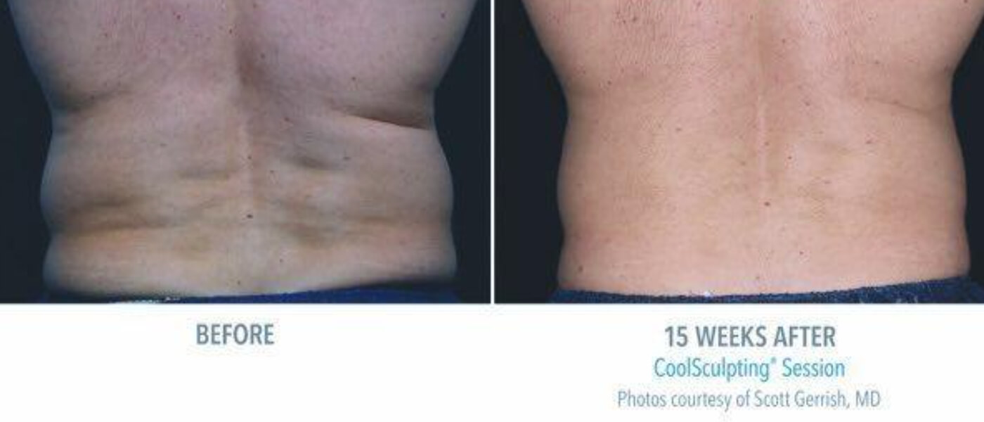 CoolSculpting® or CoolSculpting® Elite | Houston's Top Med Spa ...