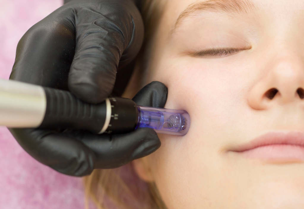 Microneedling | Houston's Top Med Spa | Persona Med Spa | Houston TX