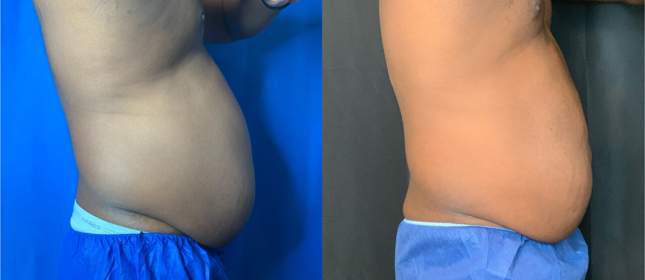 CoolSculpting® or CoolSculpting® Elite | Houston's Top Med Spa ...