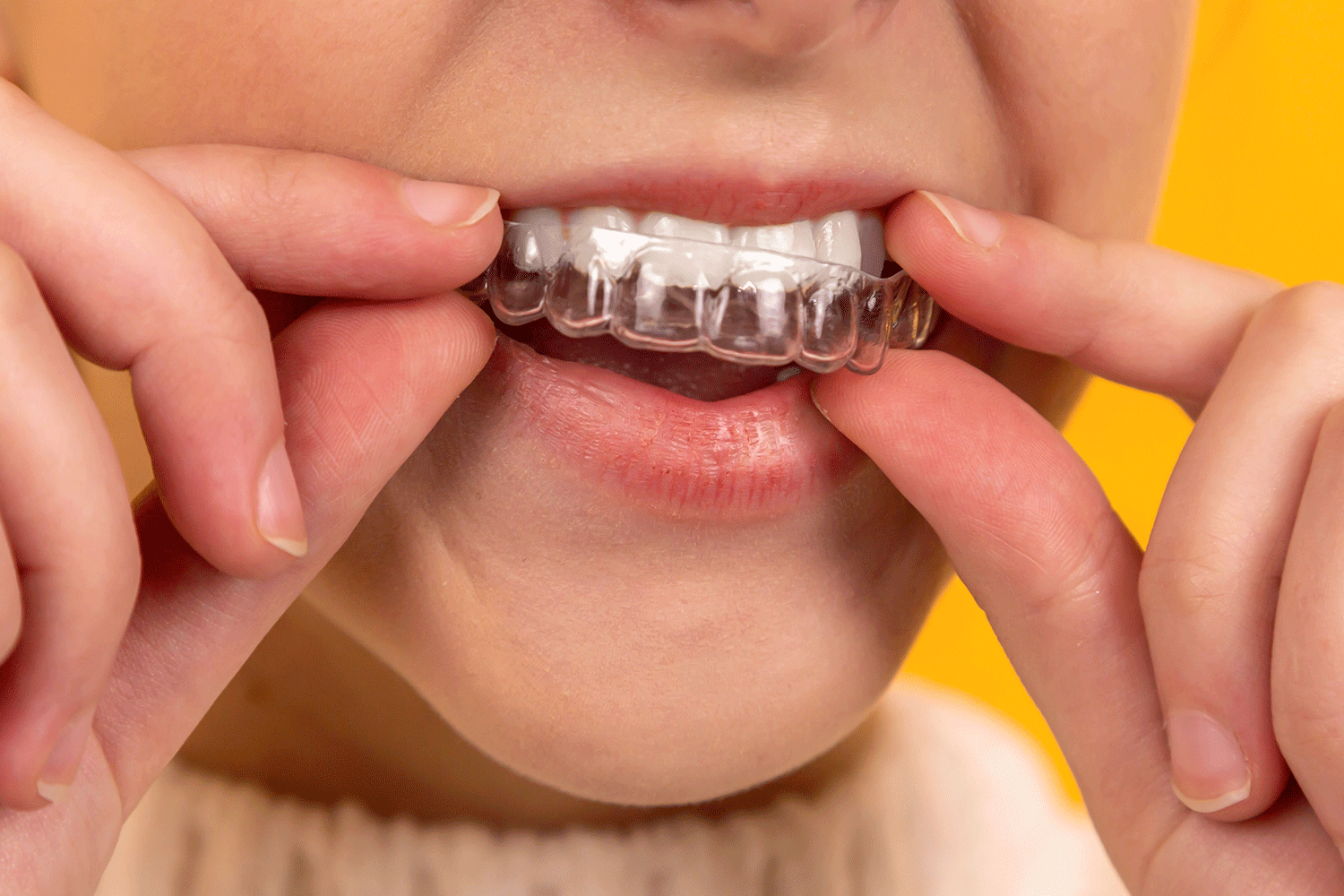 Removable Night Guards | Protect Your Smile with Our Dental Lab Services