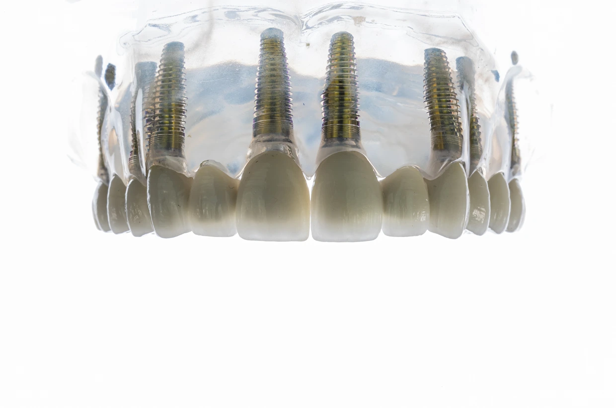 Implant Supported Bridges | Implant Solutions | Dani Dental Studio