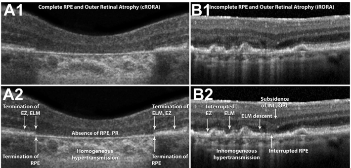 Comprehensive Assessment of Geographic Atrophy - Optical Coherence ...