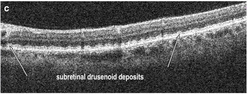 Comprehensive Assessment of Geographic Atrophy - Optical Coherence ...