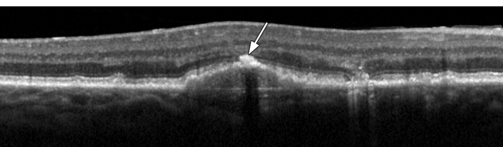 Comprehensive Assessment of Geographic Atrophy - Optical Coherence ...