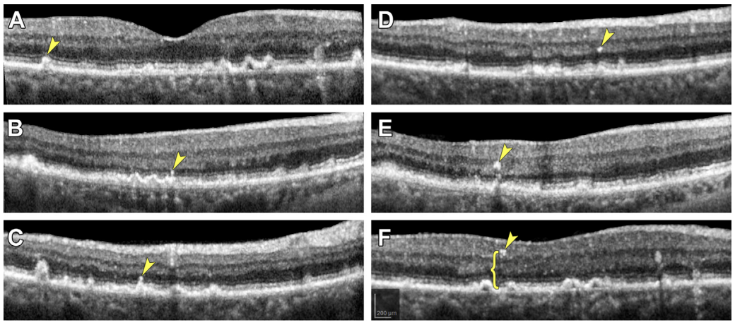 Comprehensive Assessment of Geographic Atrophy - Optical Coherence ...