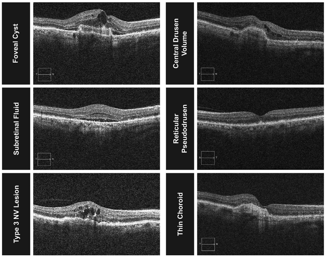 Comprehensive Assessment of Geographic Atrophy - Optical Coherence ...