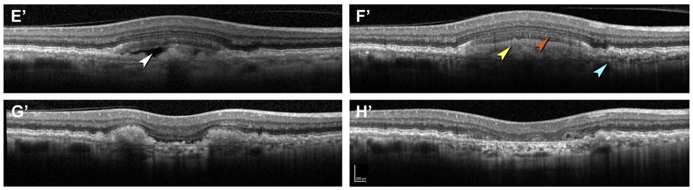 Comprehensive Assessment of Geographic Atrophy - Optical Coherence ...