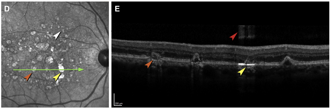 Comprehensive Assessment of Geographic Atrophy - Optical Coherence ...