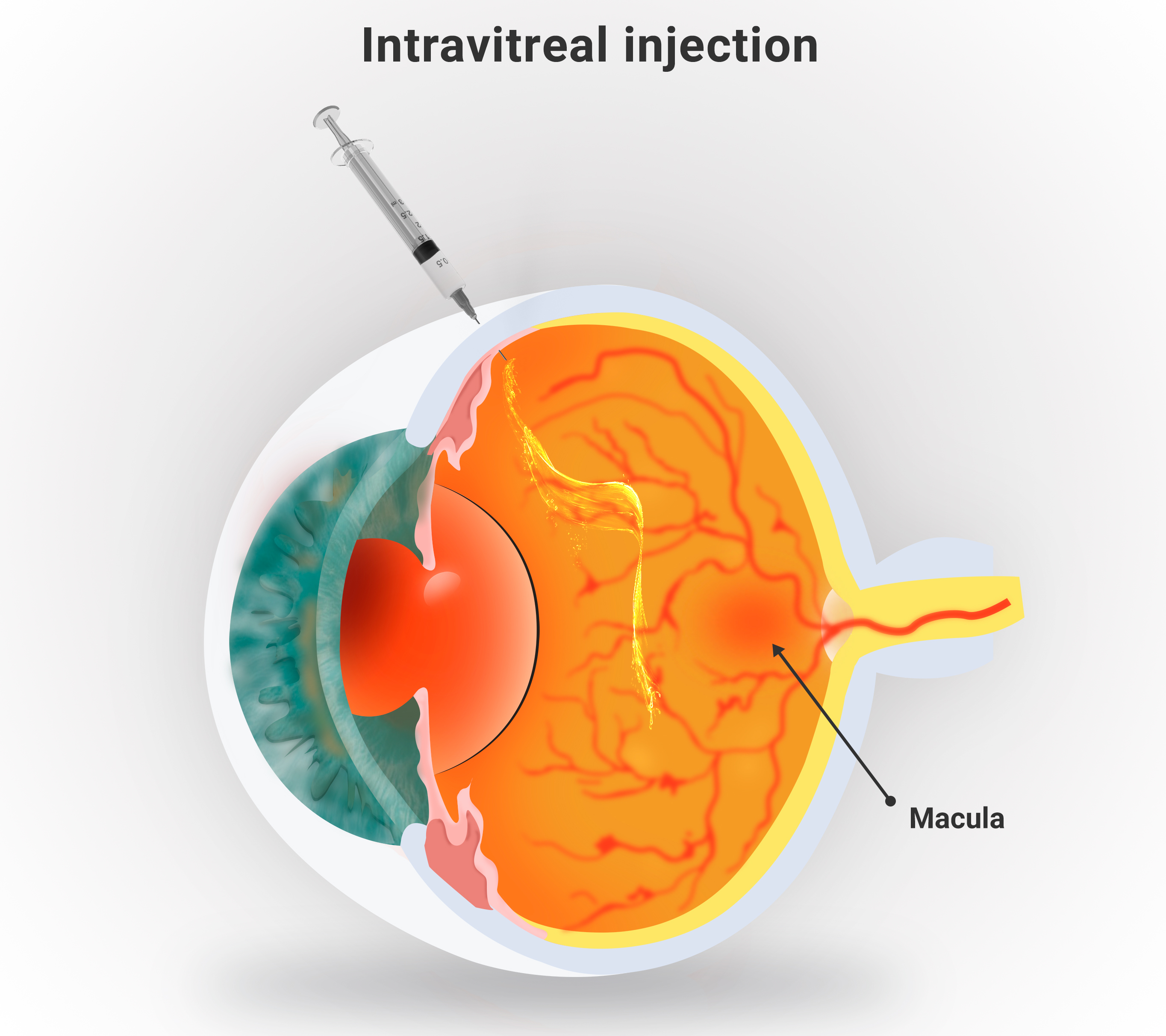 Six steps to more comfortable intravitreal injections