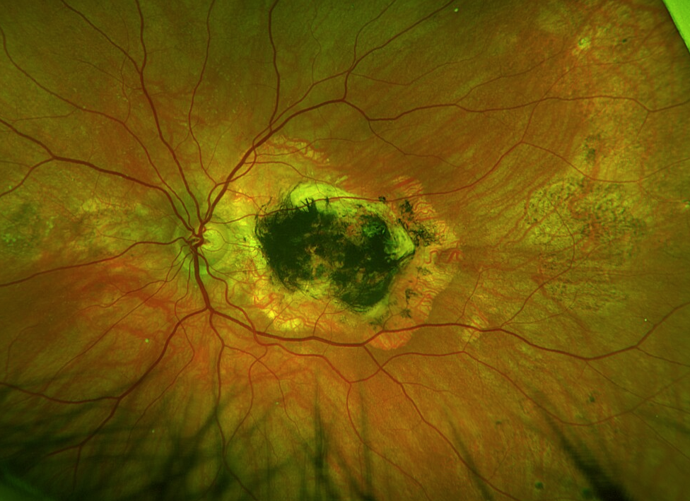 Can you tell if this embolus on Optos is real?