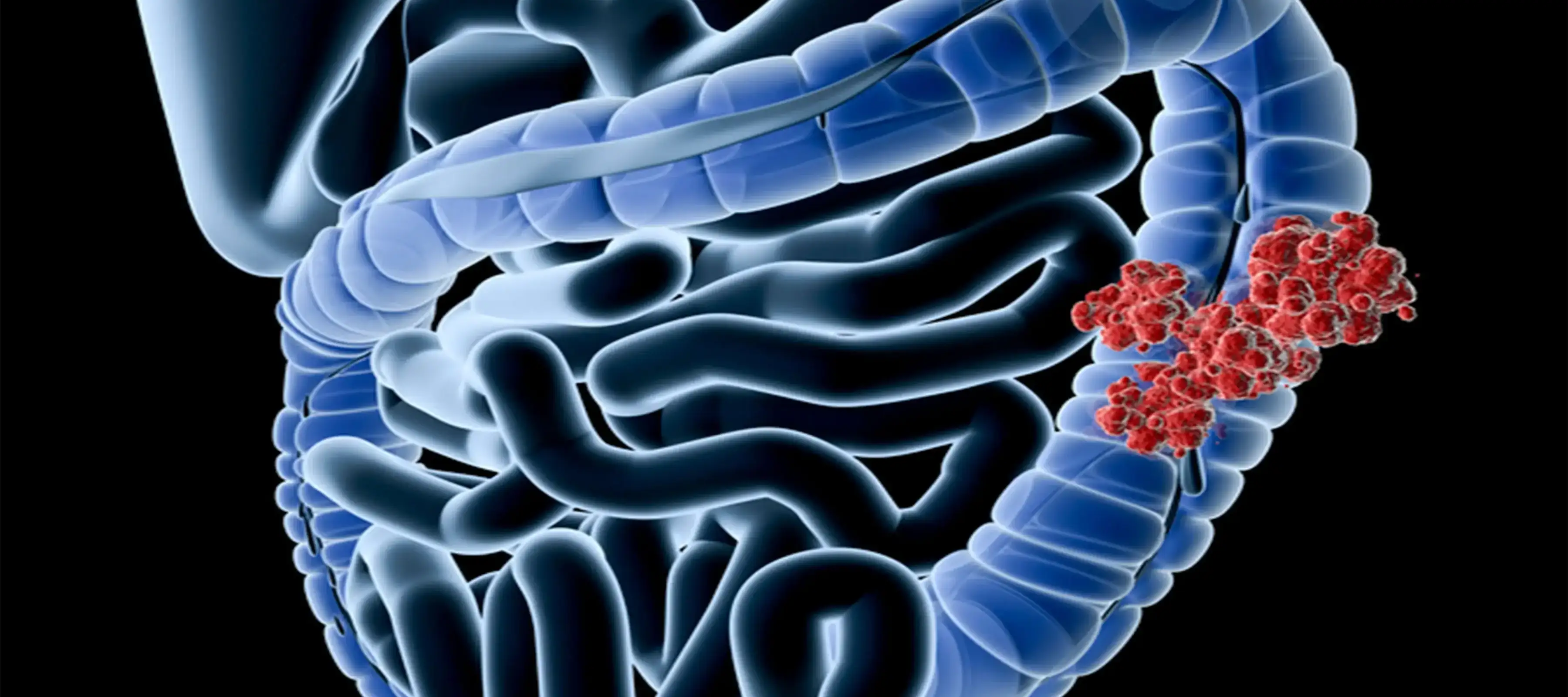 Understanding Colorectal Cancer Causes Risks And Treatments