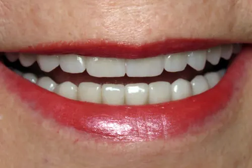 Smile Gallery | Atlanta Dental Spa