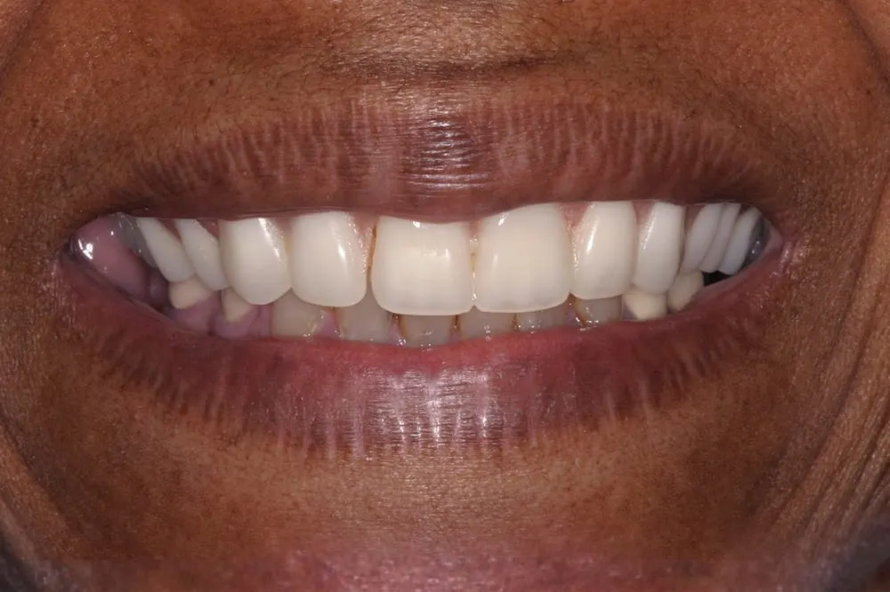 Smile Gallery | Atlanta Dental Spa