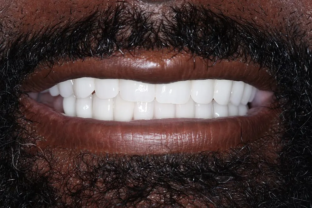 Smile Gallery | Atlanta Dental Spa