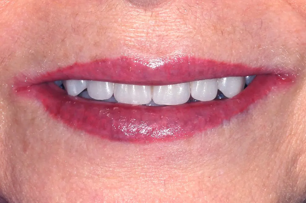 Smile Gallery | Atlanta Dental Spa