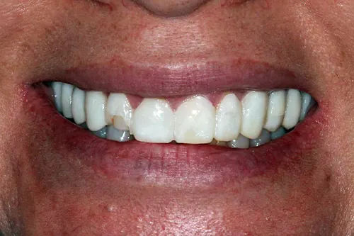 Smile Gallery | Atlanta Dental Spa