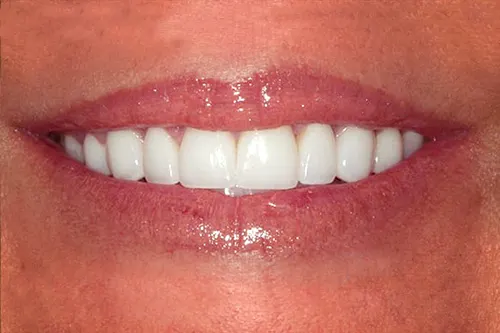 No-Prep Veneers in Atlanta | Atlanta Dental Spa
