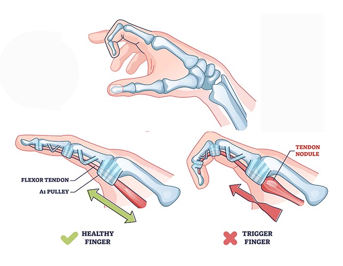 More About Common questions asked of a trigger finger release doctor