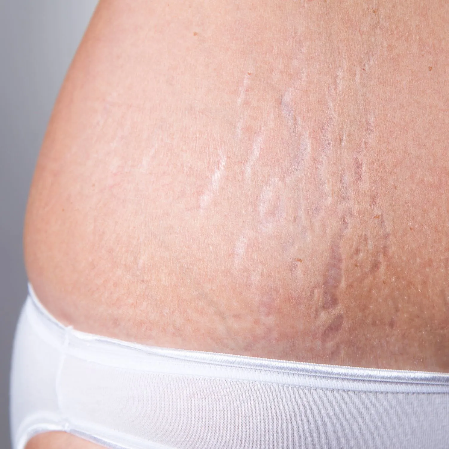 Tratamiento de estrías | Clínica Danella Elaluf