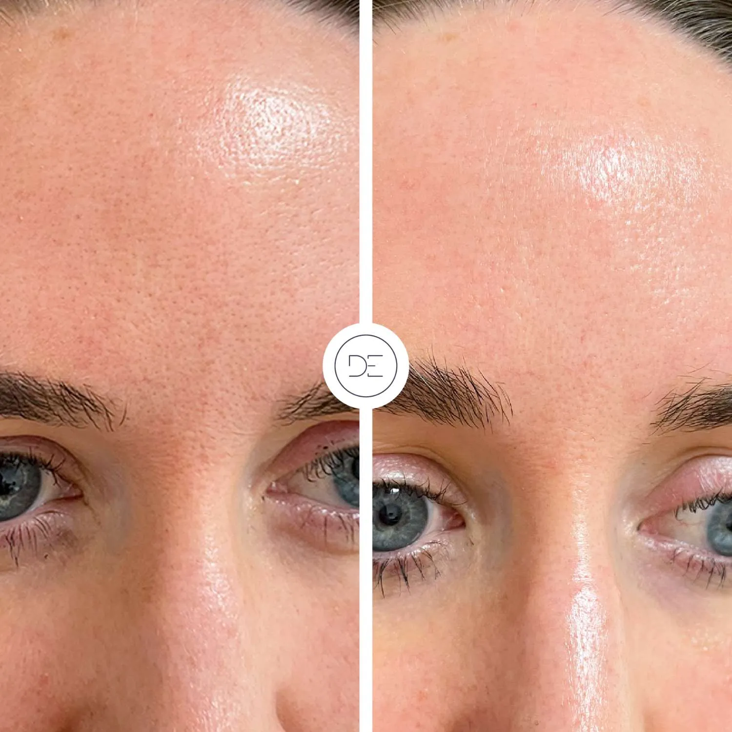 Black Peel | Clínica Danella Elaluf