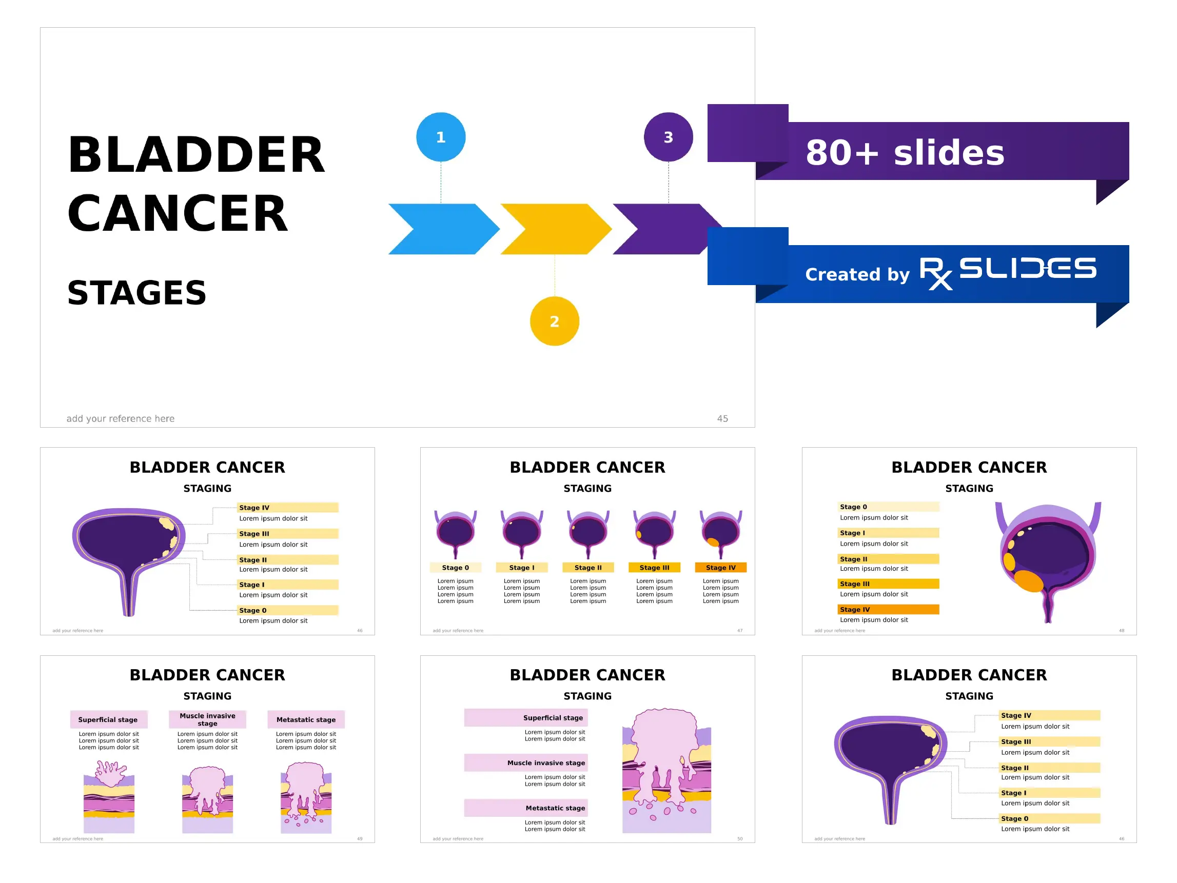 Download Bladder Cancer PowerPoint Template|RxSlides
