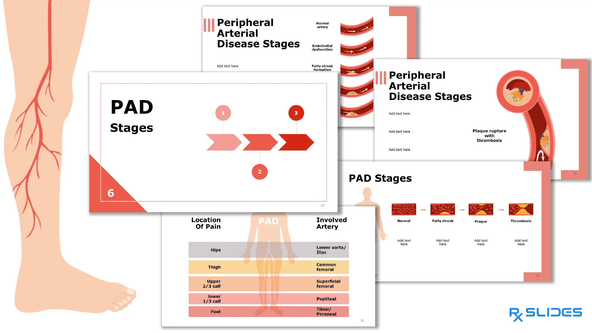 Download Peripheral Arterial Disease PowerPoint Template| RxSlides