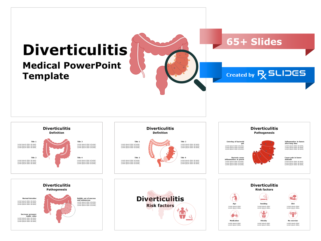 Download Diverticulitis PowerPoint Template| RxSlides