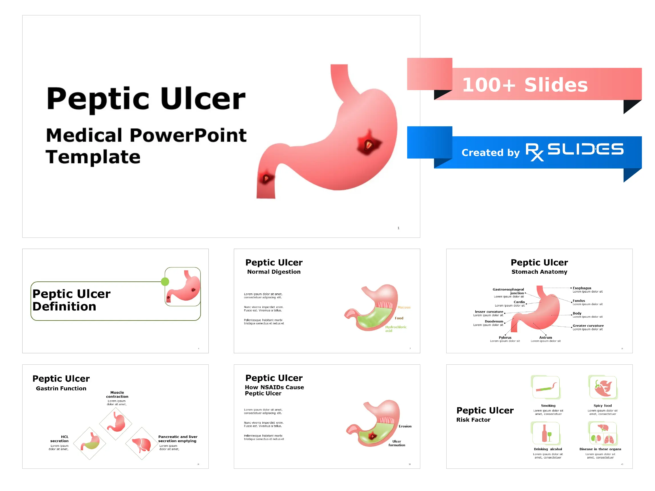 Download Peptic Ulcer PowerPoint Template| RxSlides