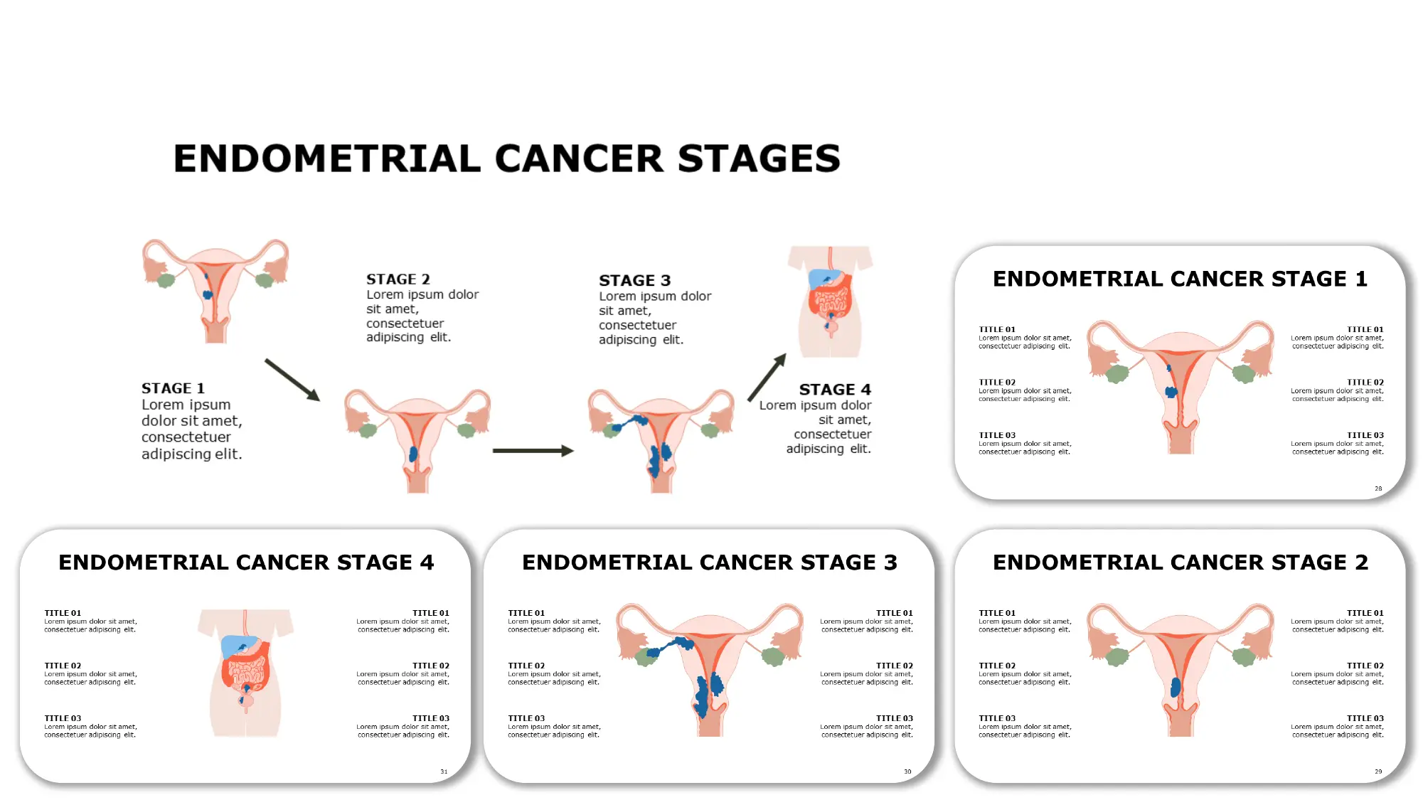 Download Endometrial Cancer PowerPoint Template| RxSlides