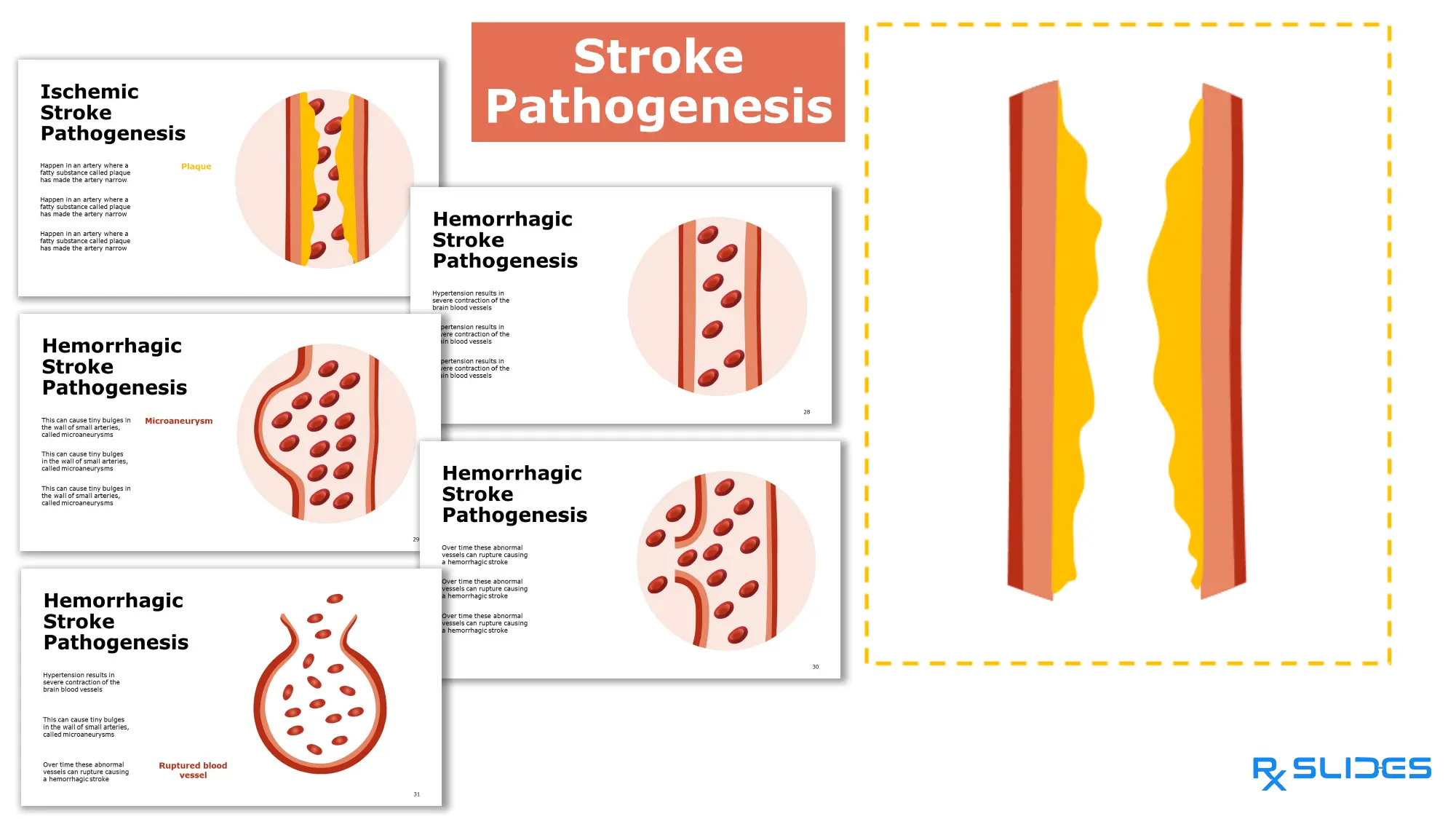 Download Stroke PowerPoint Template|