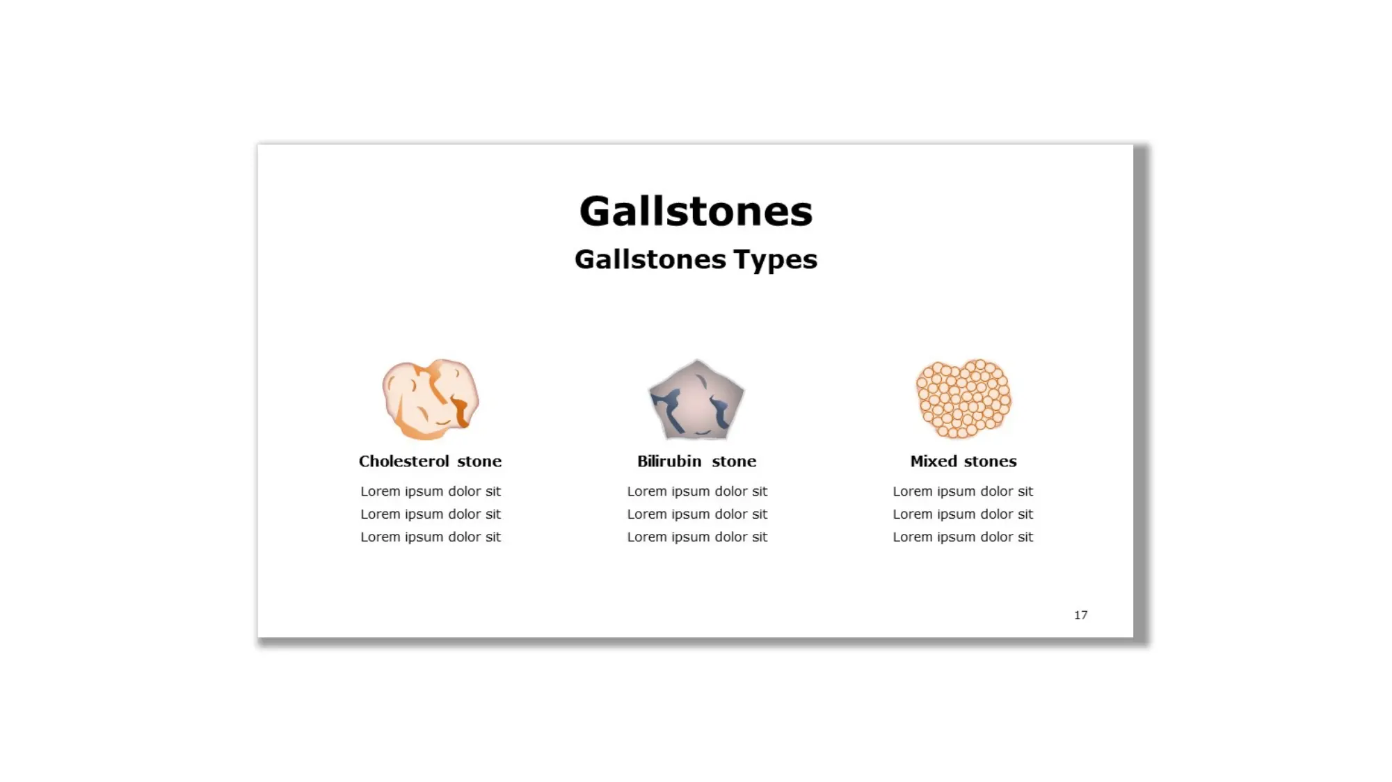 Download Gallstones PowerPoint Template| RxSlides