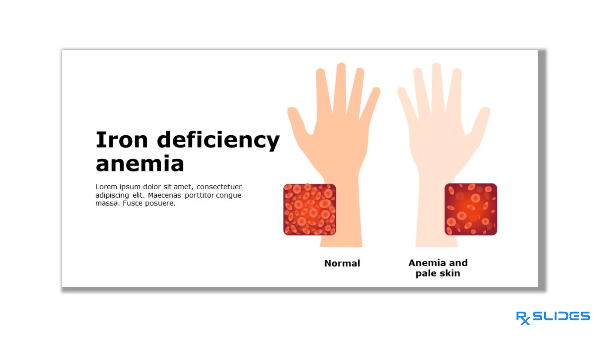 Download Iron Deficiency Anemia PowerPoint Template | RxSlides