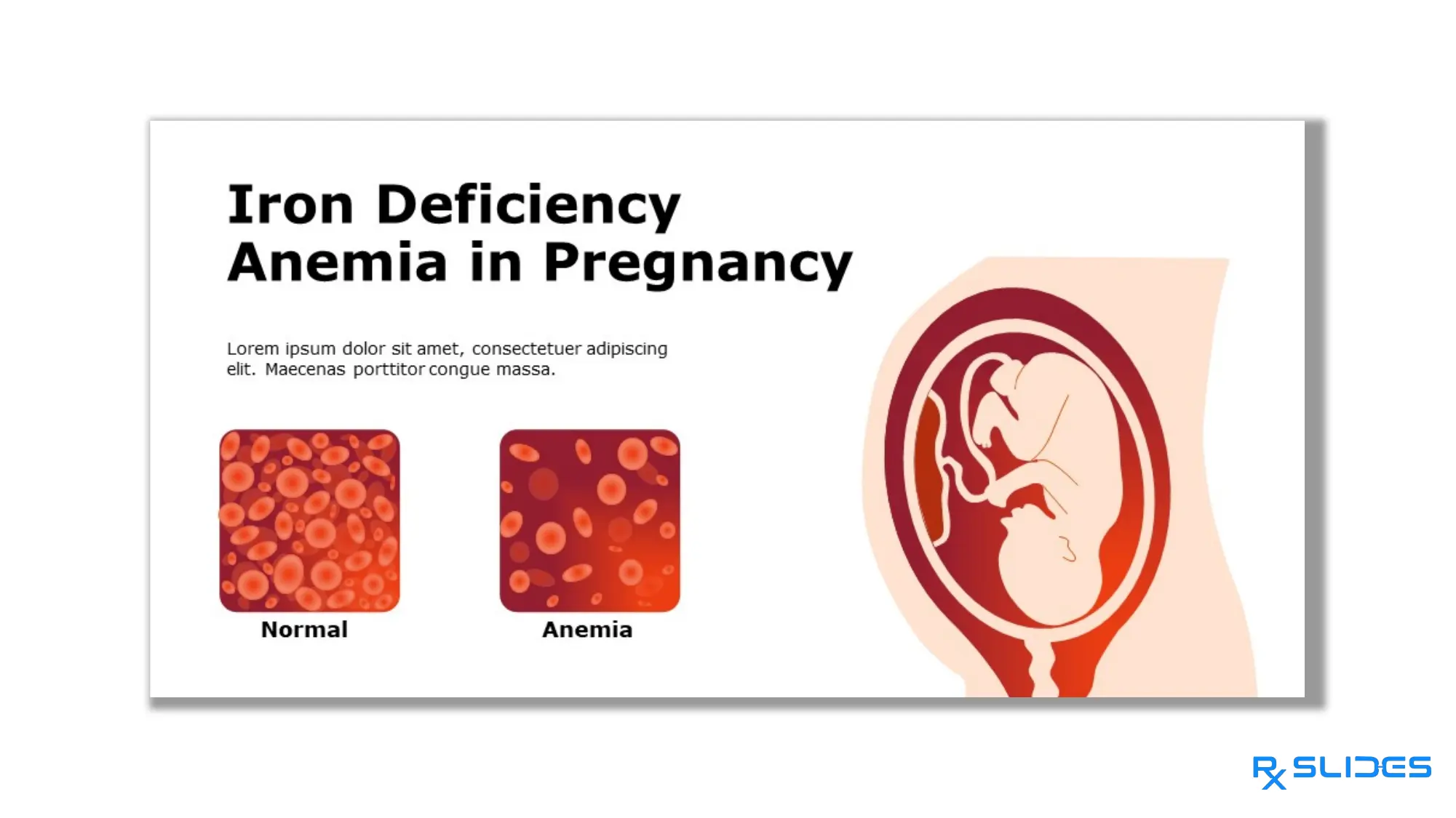Download Iron Deficiency Anemia PowerPoint Template | RxSlides