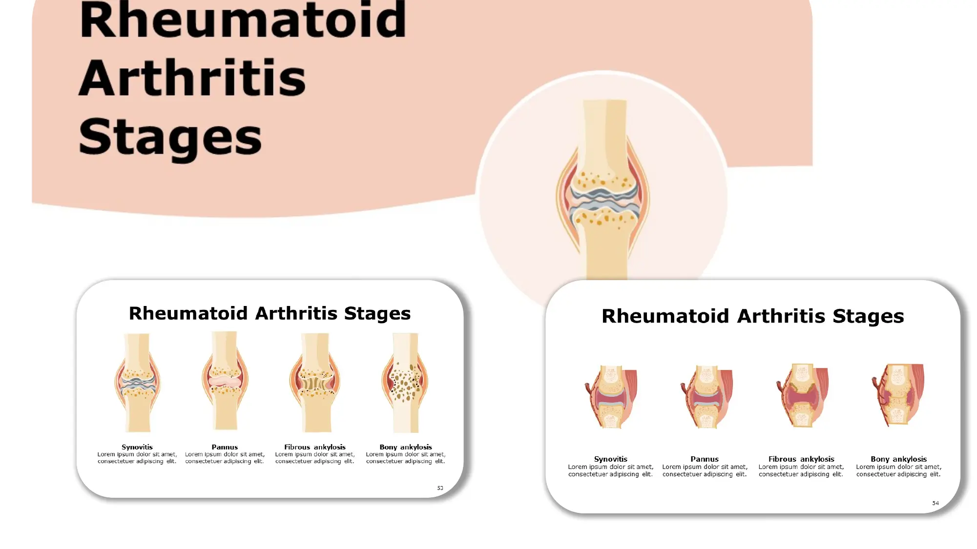 Download Rheumatoid Arthritis PowerPoint Template|RxSlides